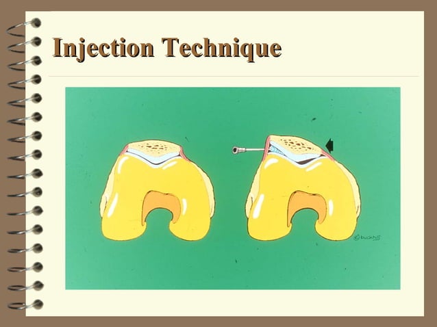 Supartz injection techniques | PPT