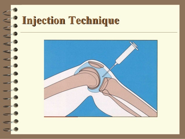 Supartz injection techniques