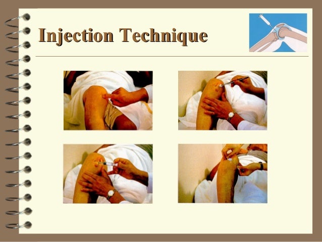 Supartz injection techniques