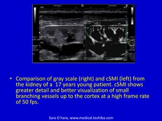 Superb microvascular imaging A Sonographic Technical AdvanceDr ...