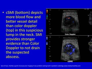 Superb microvascular imaging A Sonographic Technical AdvanceDr ...