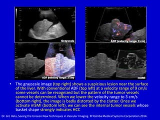 Superb microvascular imaging A Sonographic Technical AdvanceDr ...
