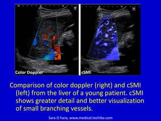 Superb microvascular imaging A Sonographic Technical AdvanceDr ...