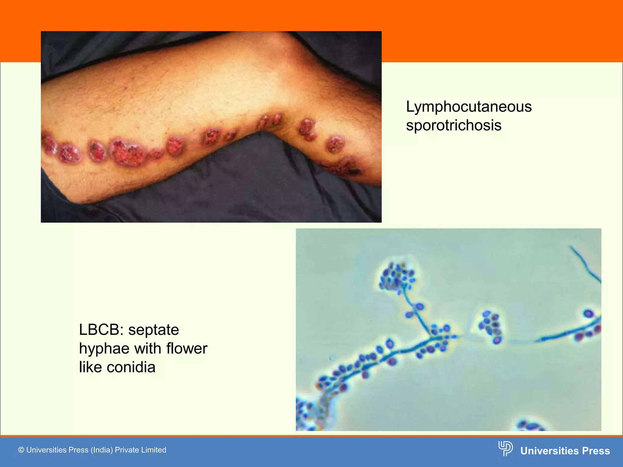 Superfical and Subcut fungal inf.pptx