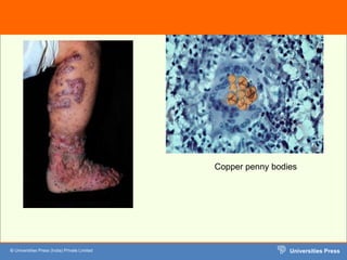 Copper Penny Rash