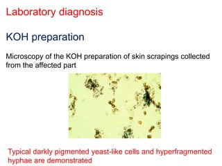 Superficial and cutaneous mycoses | PPTX