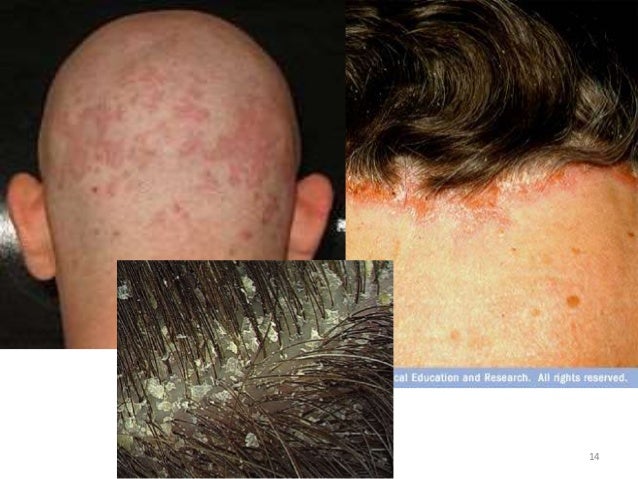 Superficial and cutaneous mycoses