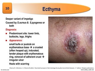 Superficial bacterial infection | PPT