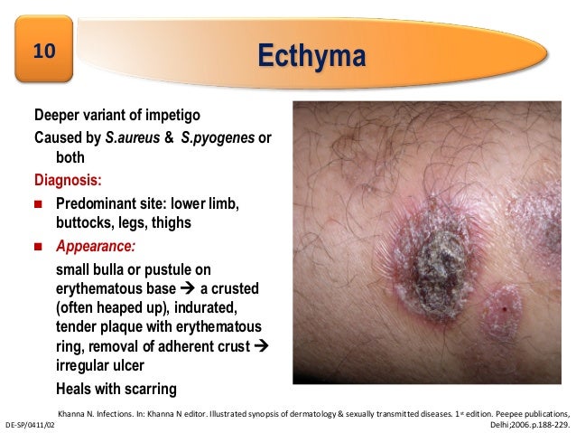 Superficial bacterial infection