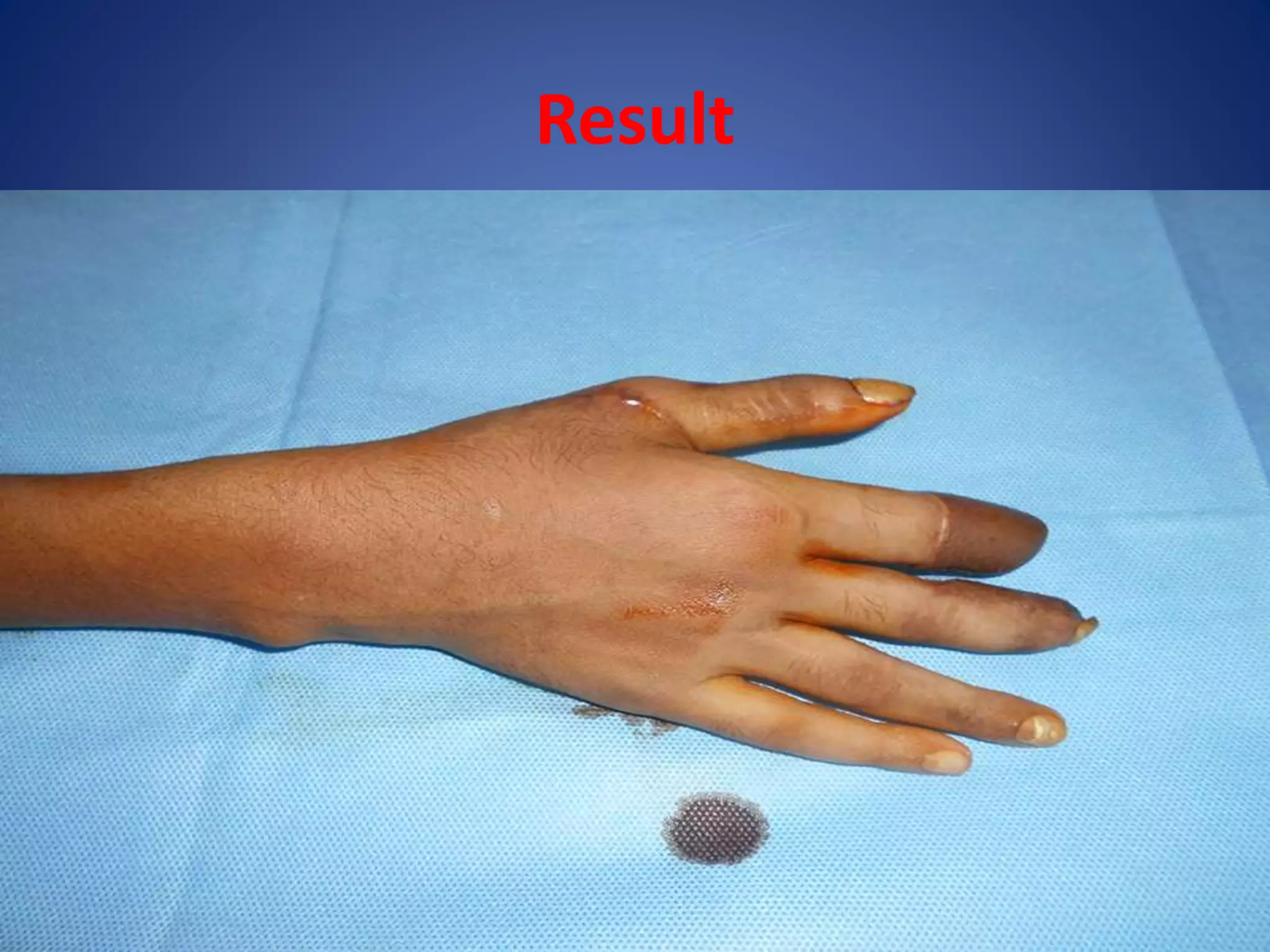 Superficial circumflex iliac artery perforator flap | PPTX