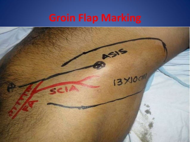 Superficial circumflex iliac artery perforator flap | PPTX | First Aid ...