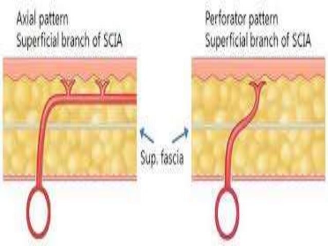 Superficial circumflex iliac artery perforator flap | PPTX | First Aid ...