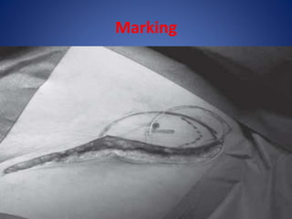 Superficial circumflex iliac artery perforator flap | PPTX