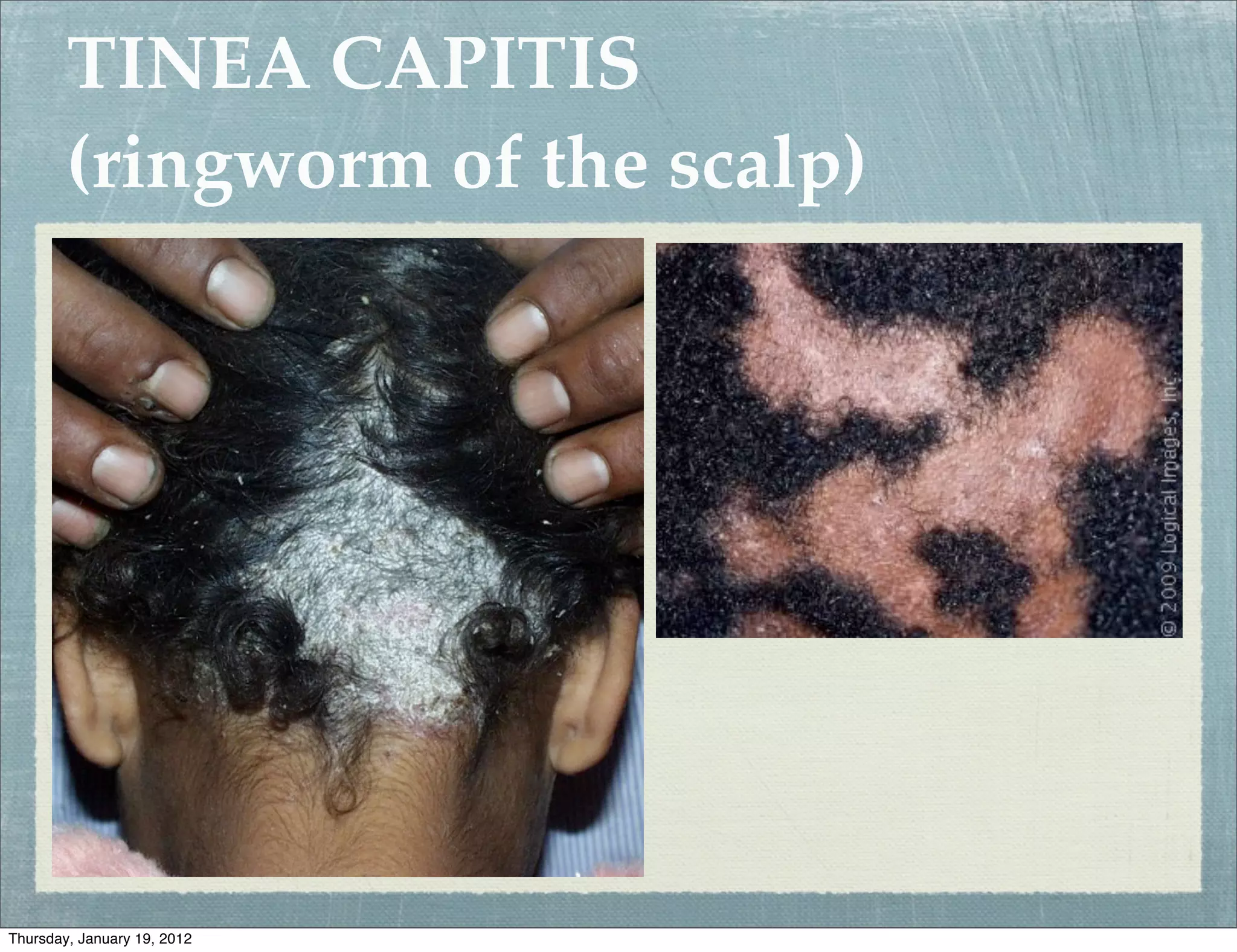 Superficial:cutaneous mycoses | PDF