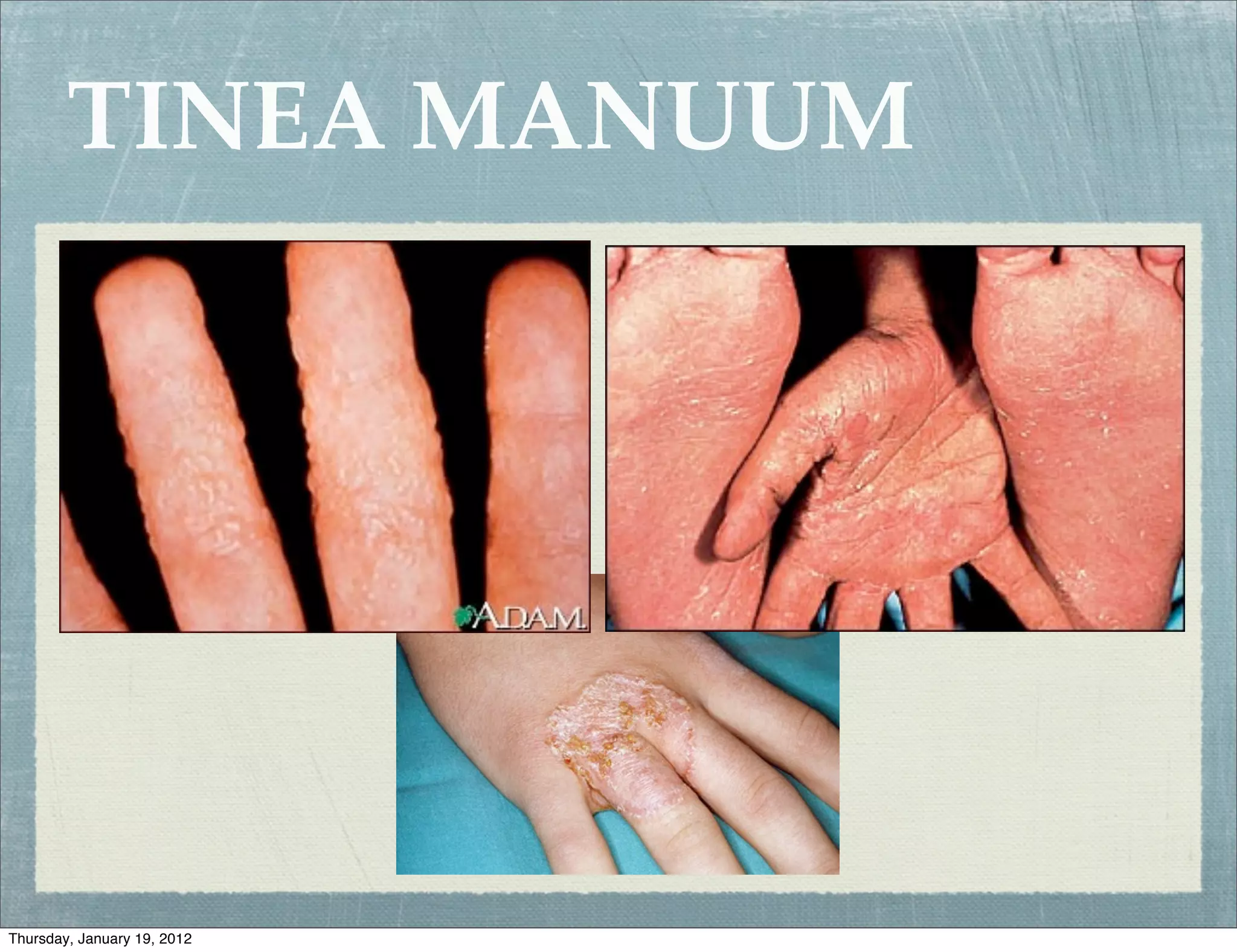 Superficial:cutaneous mycoses | PDF