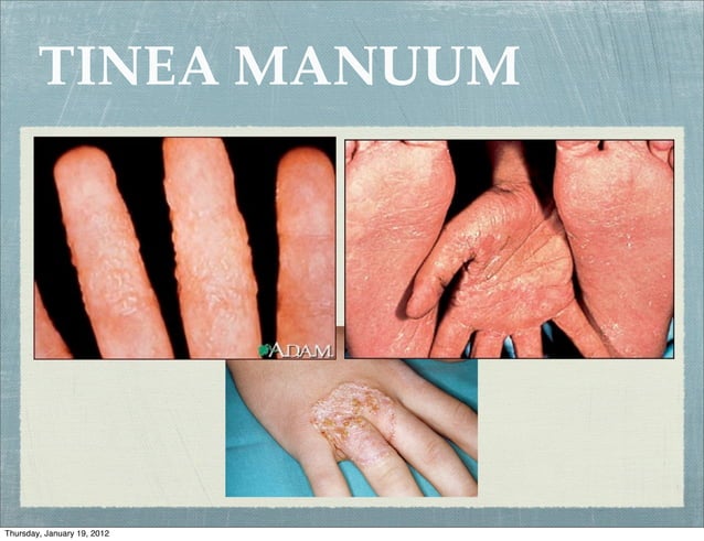 Superficial:cutaneous mycoses | PDF | Skin and Dermatology | Diseases ...