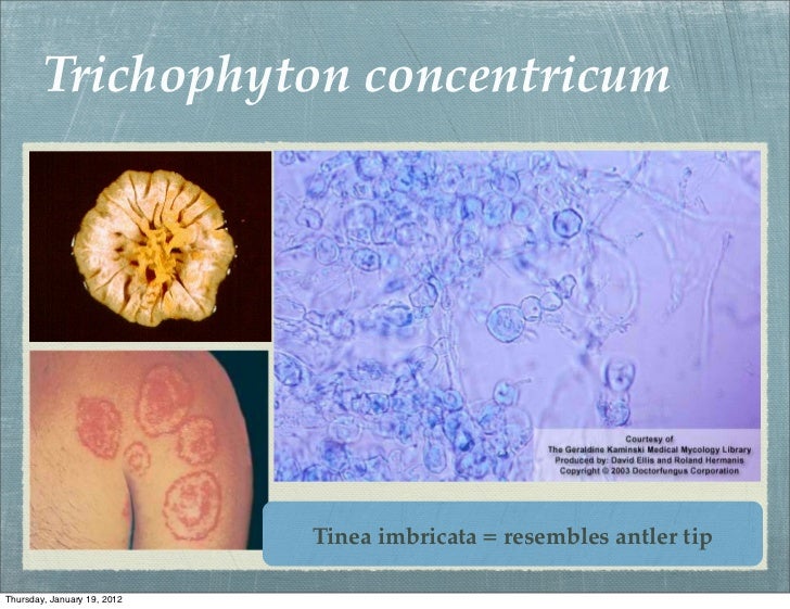 Superficial:cutaneous mycoses
