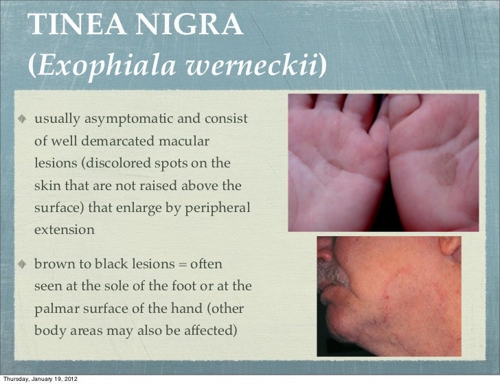 Superficial:cutaneous mycoses