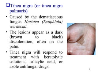 Superficial & cutaneous mycoses | PPT