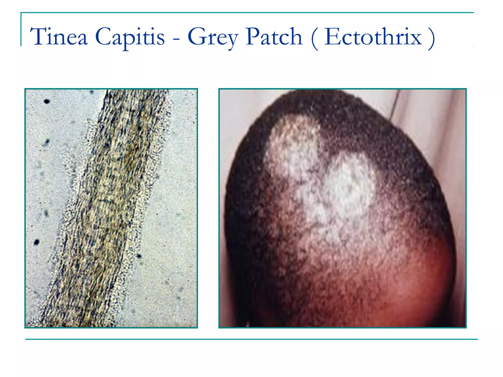 Superficial fungal infections | PPT
