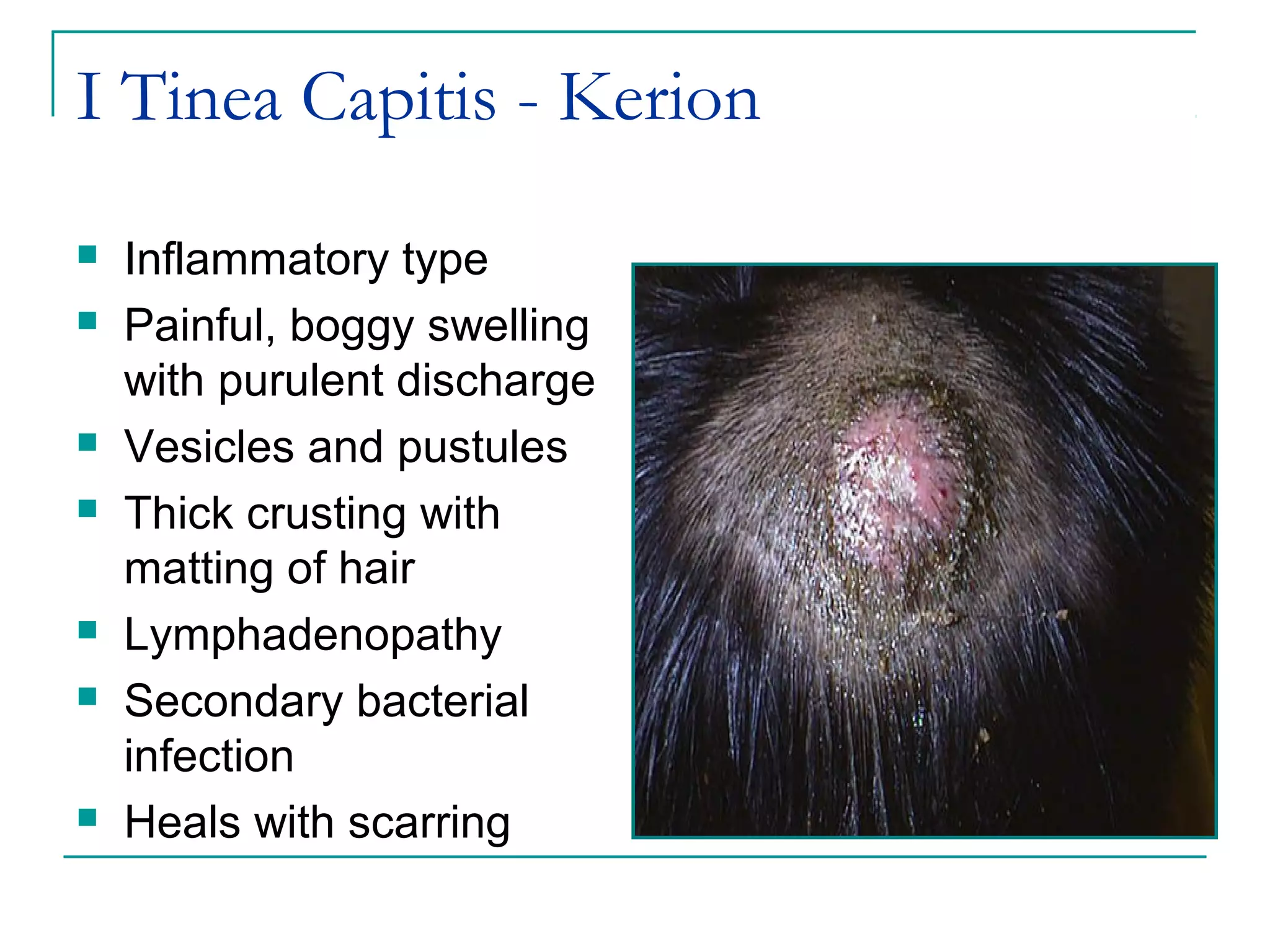 Superficial fungal infections | PPT