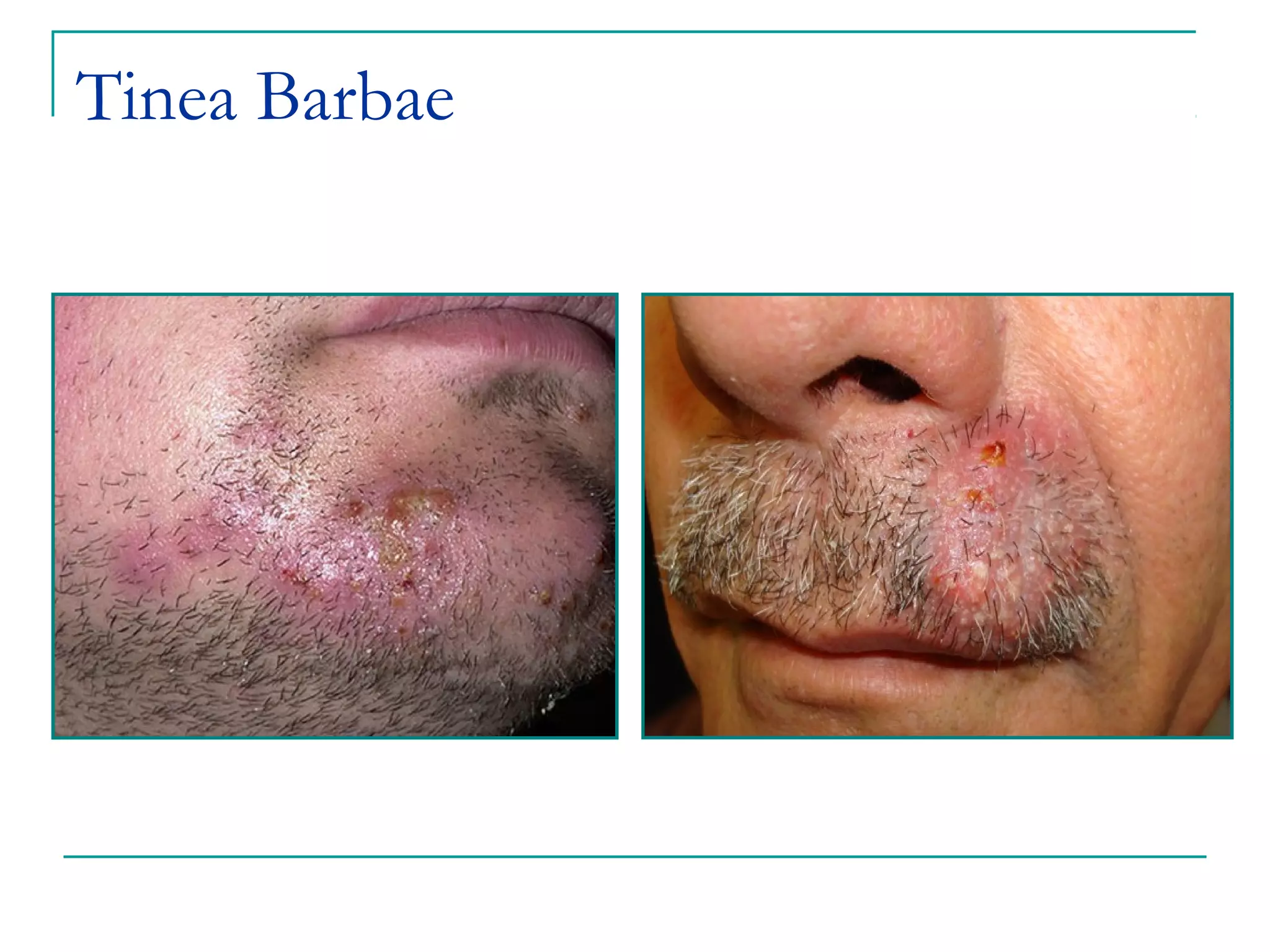 Superficial fungal infections | PPT