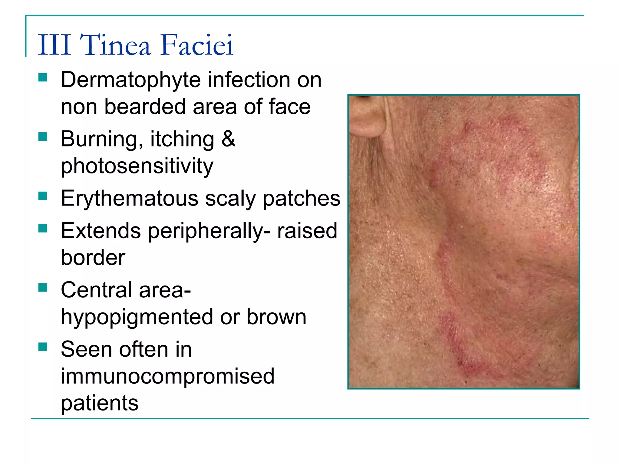 Superficial fungal infections | PPT