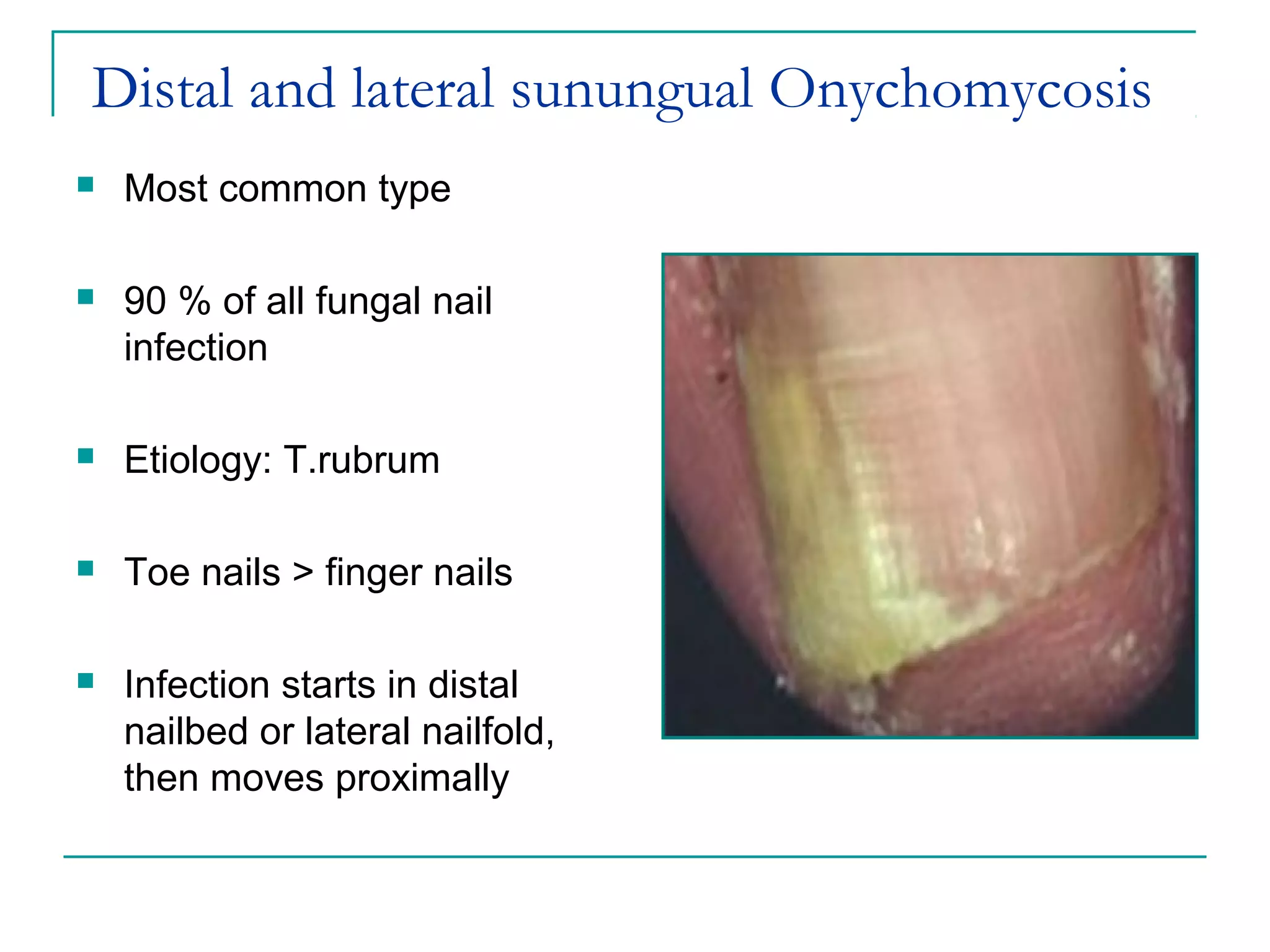 Superficial fungal infections | PPT