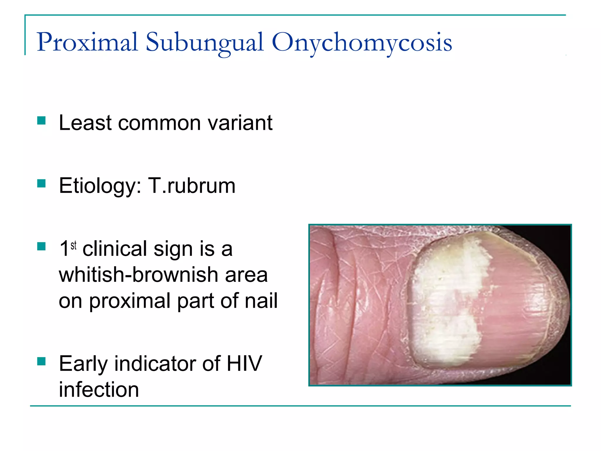 Superficial fungal infections | PPT