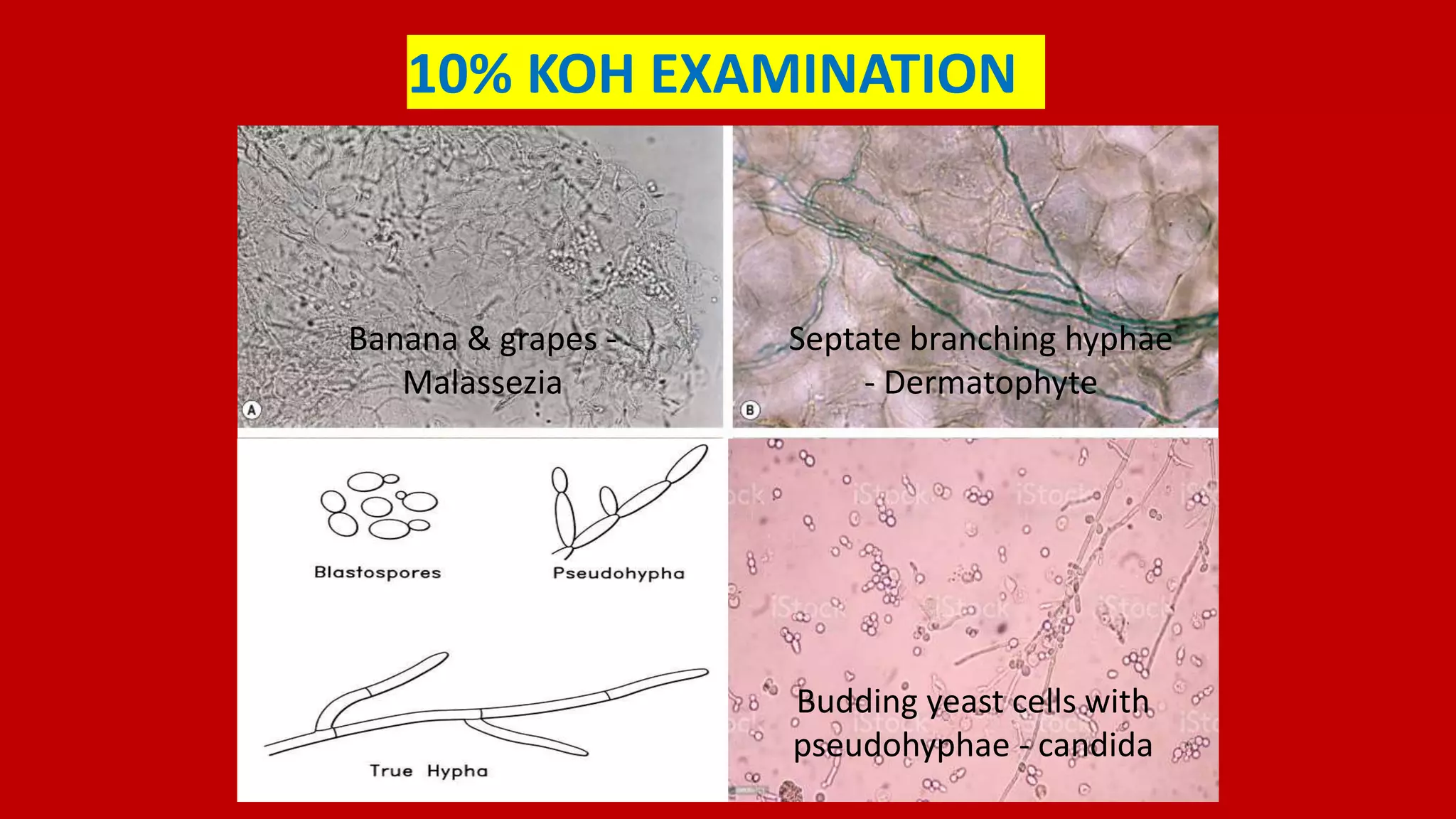 Superficial Fungal Infections | PPTX