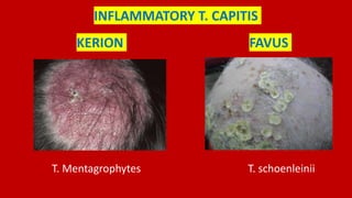Superficial Fungal Infections | PPTX