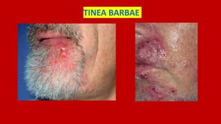 Superficial Fungal Infections | PPTX