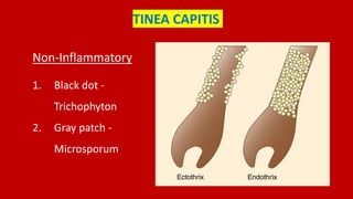 Superficial Fungal Infections | PPTX