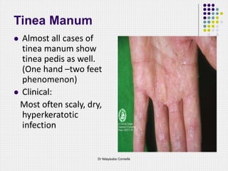 Superficial fungal infections.pdf