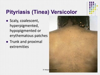 Superficial fungal infections.pdf | Skin Care | Beauty