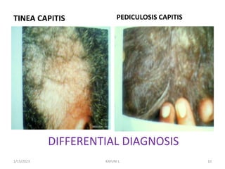superficial fungal infections.pptx