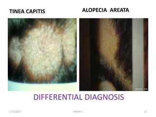 superficial fungal infections.pptx