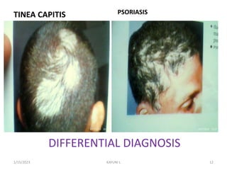 superficial fungal infections.pptx