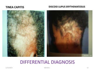 superficial fungal infections.pptx
