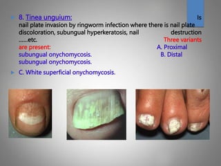 Superficial fungal skin infections.ppt