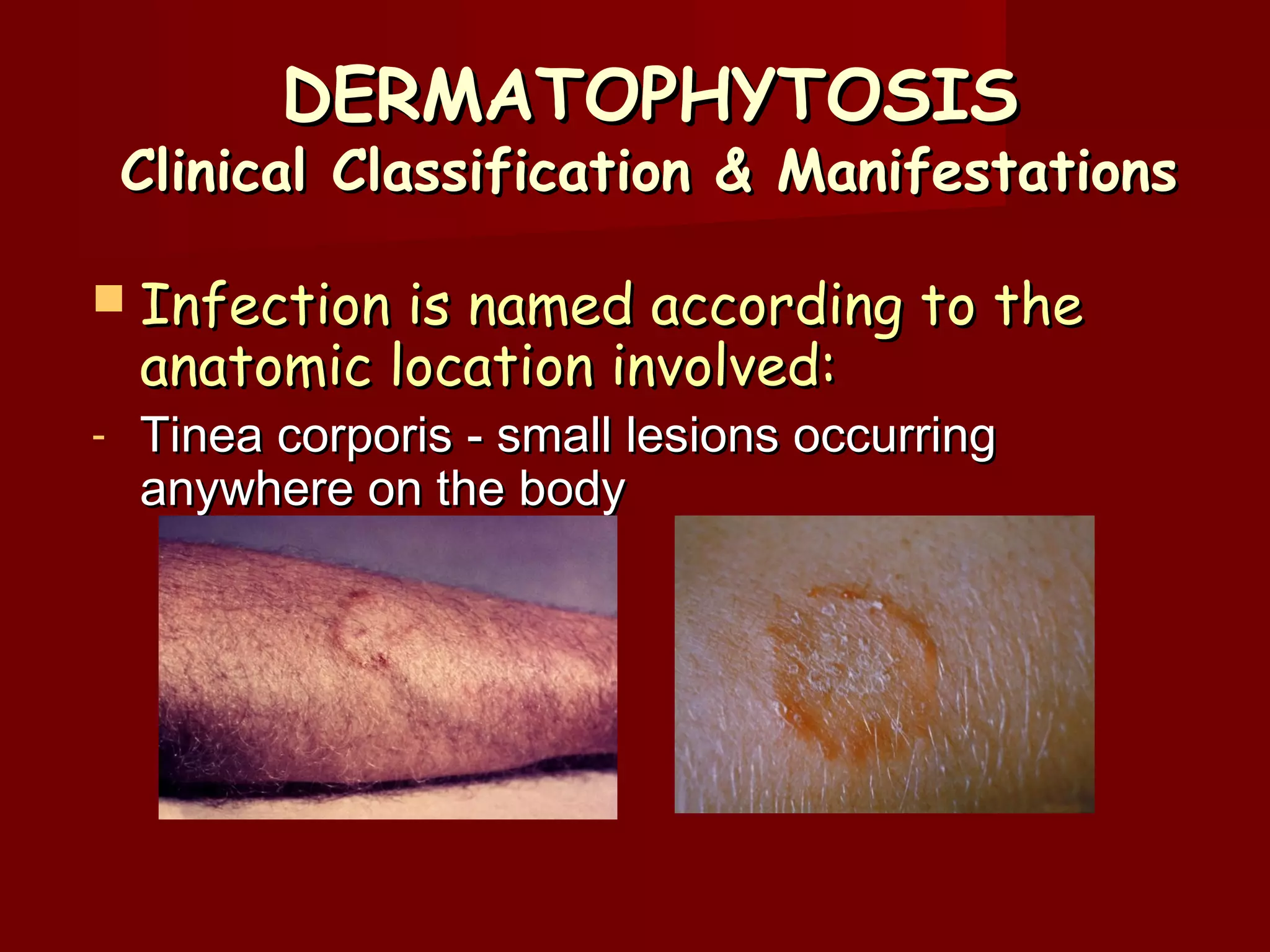 Superficial mycoses | PPT