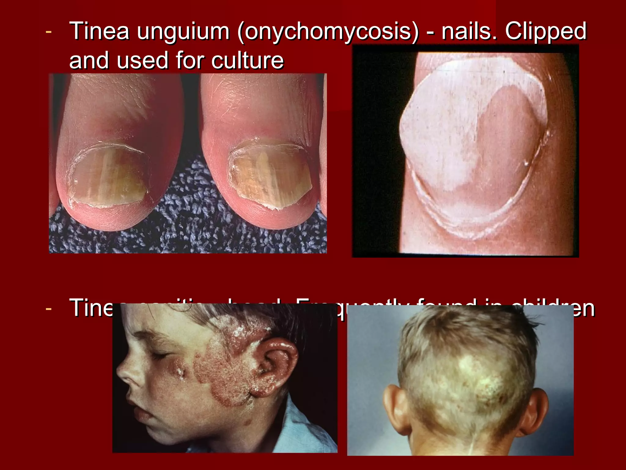 Superficial mycoses | PPT