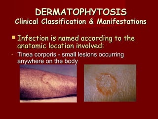 Superficial mycoses | PPT
