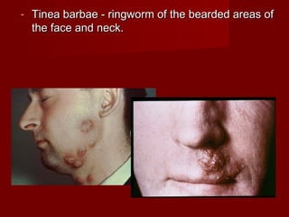 Superficial mycoses | PPT