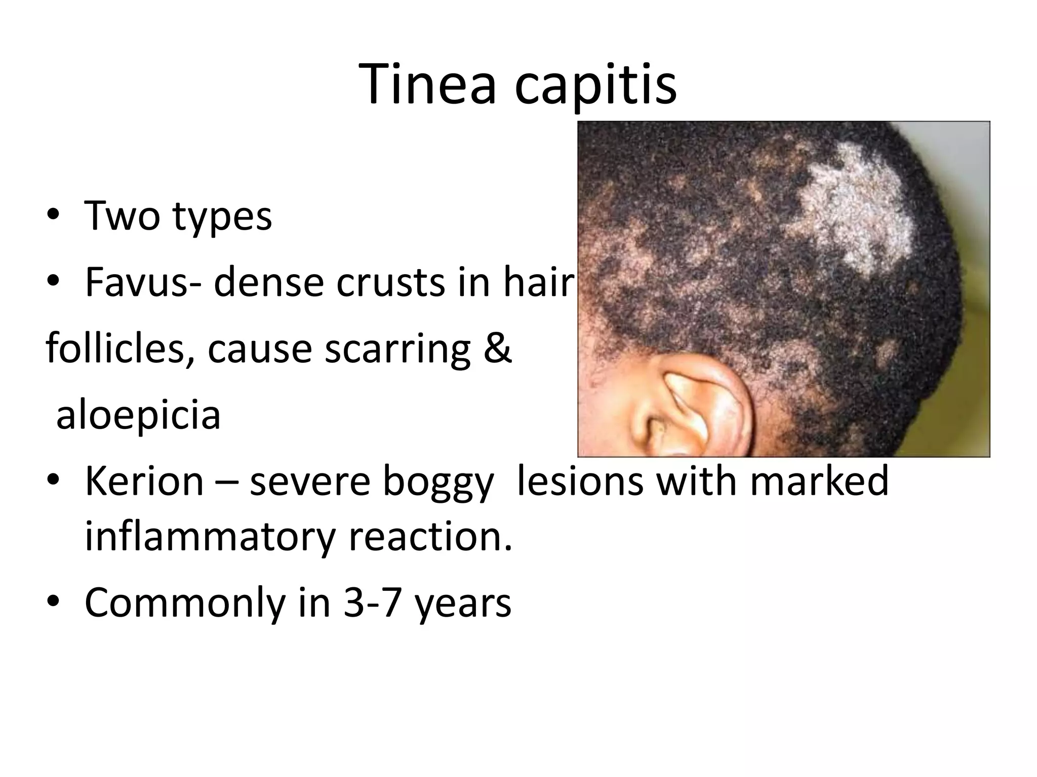 Superficial mycoses | PPTX