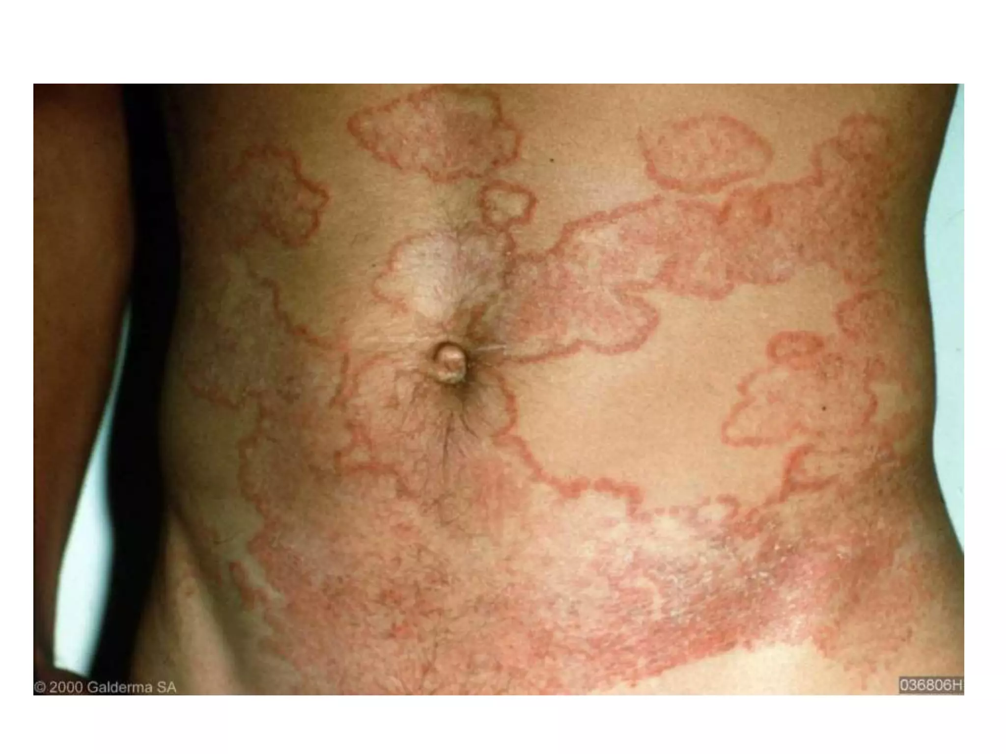 Superficial mycoses | PPTX