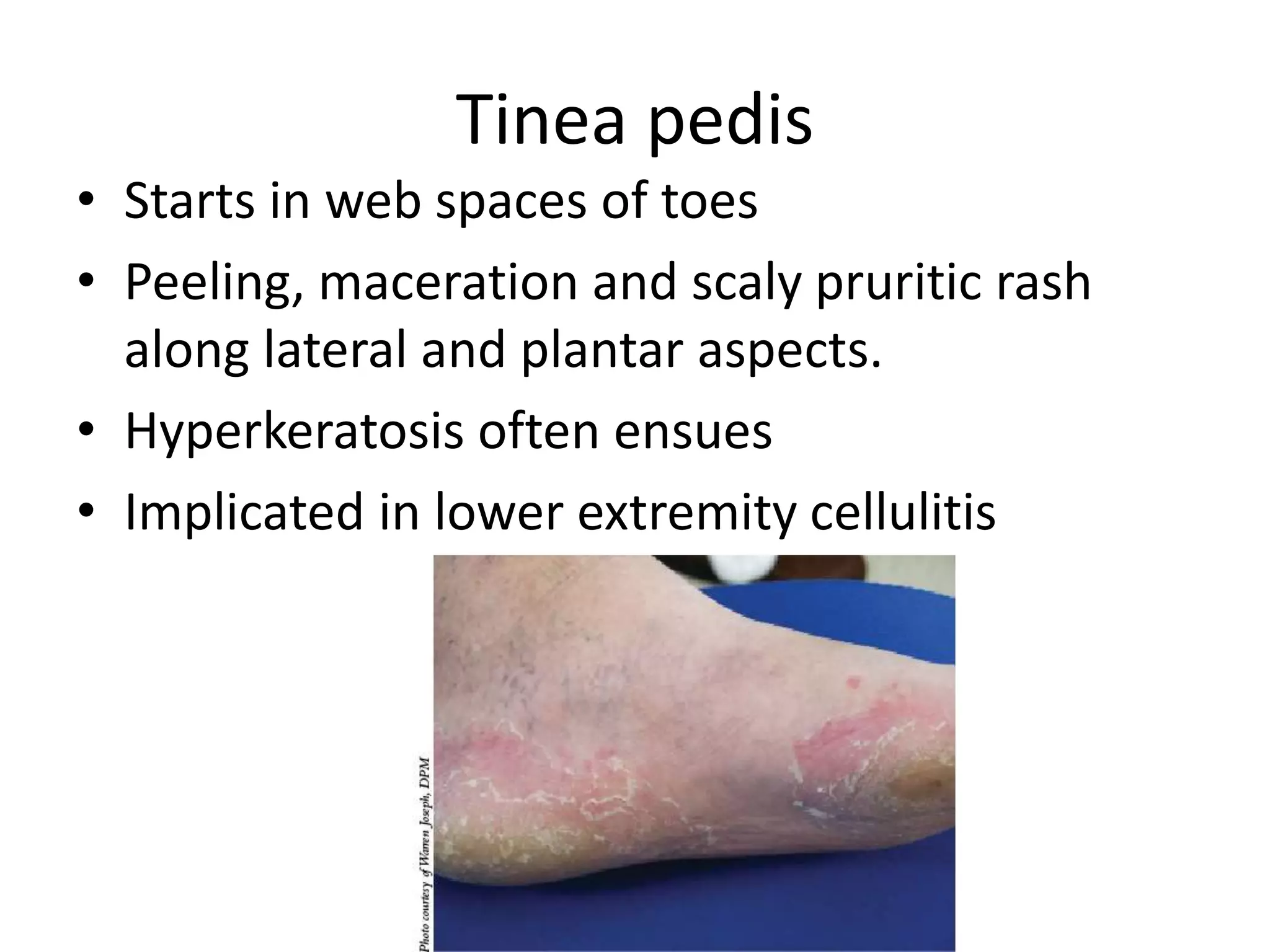 Superficial mycoses | PPTX