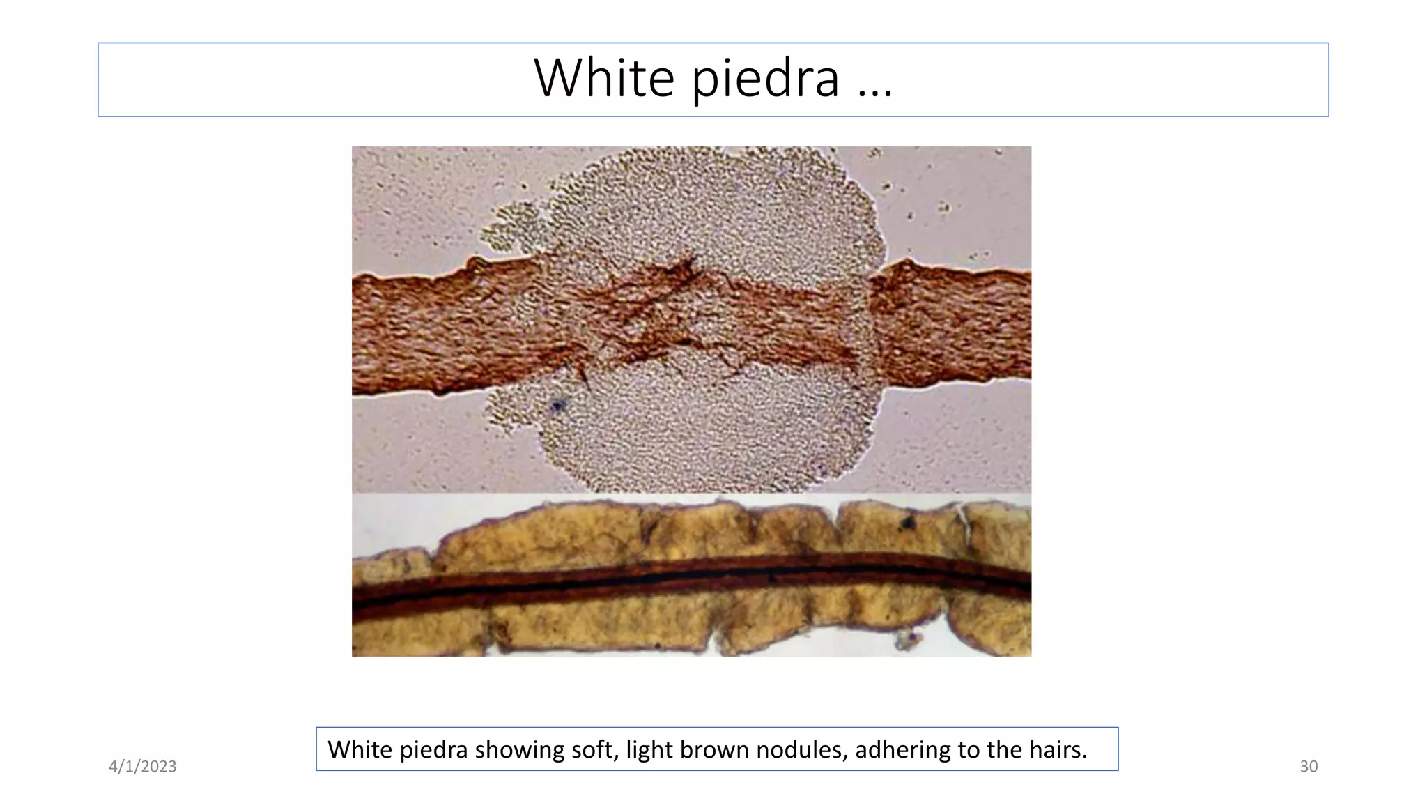 Superficial Mycoses.pptx