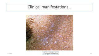 Superficial Mycoses.pptx