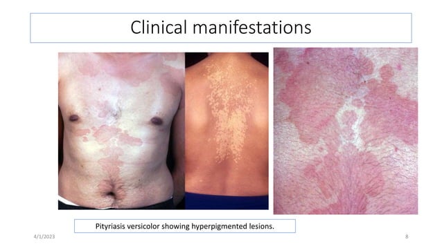 Superficial Mycoses.pptx